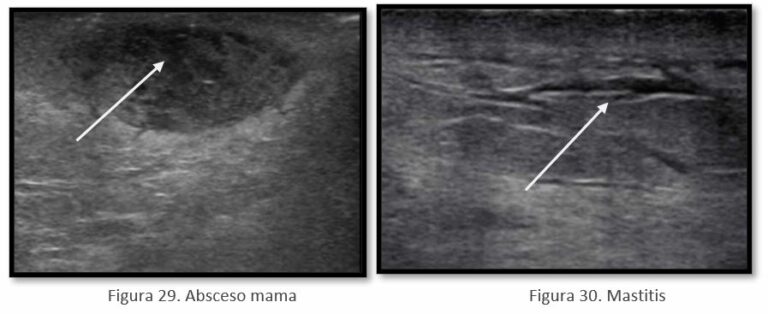 Ecografía de la mama en atención primaria - SAMFyC