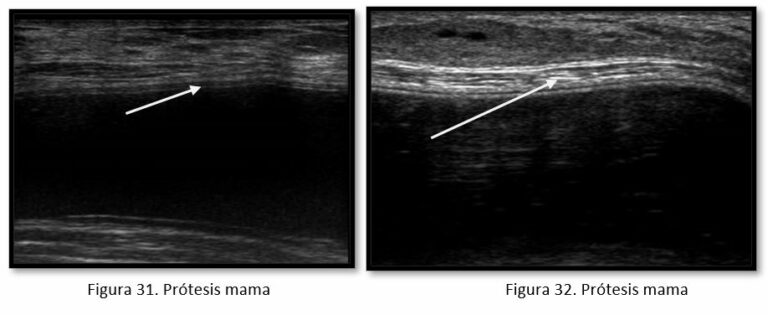 Ecografía de la mama en atención primaria - SAMFyC