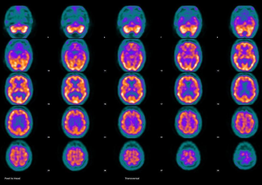 Complicaciones Neurológicas Post-COVID: revisión de la evidencia ...